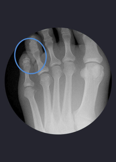 Helomas interdigitales: Callosidades entre los dedos u "ojos de gallo ...