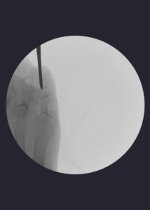 Helomas interdigitales: Callosidades entre los dedos u "ojos de gallo ...