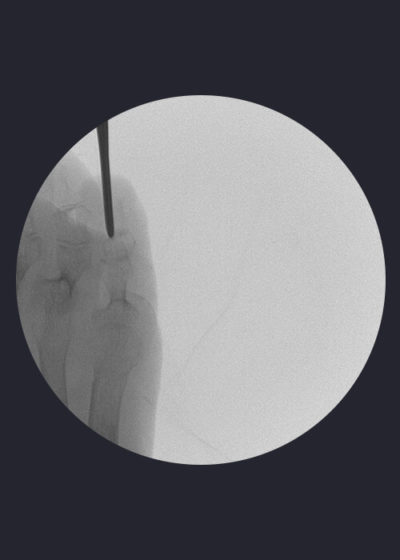 Helomas interdigitales: Callosidades entre los dedos u "ojos de gallo ...