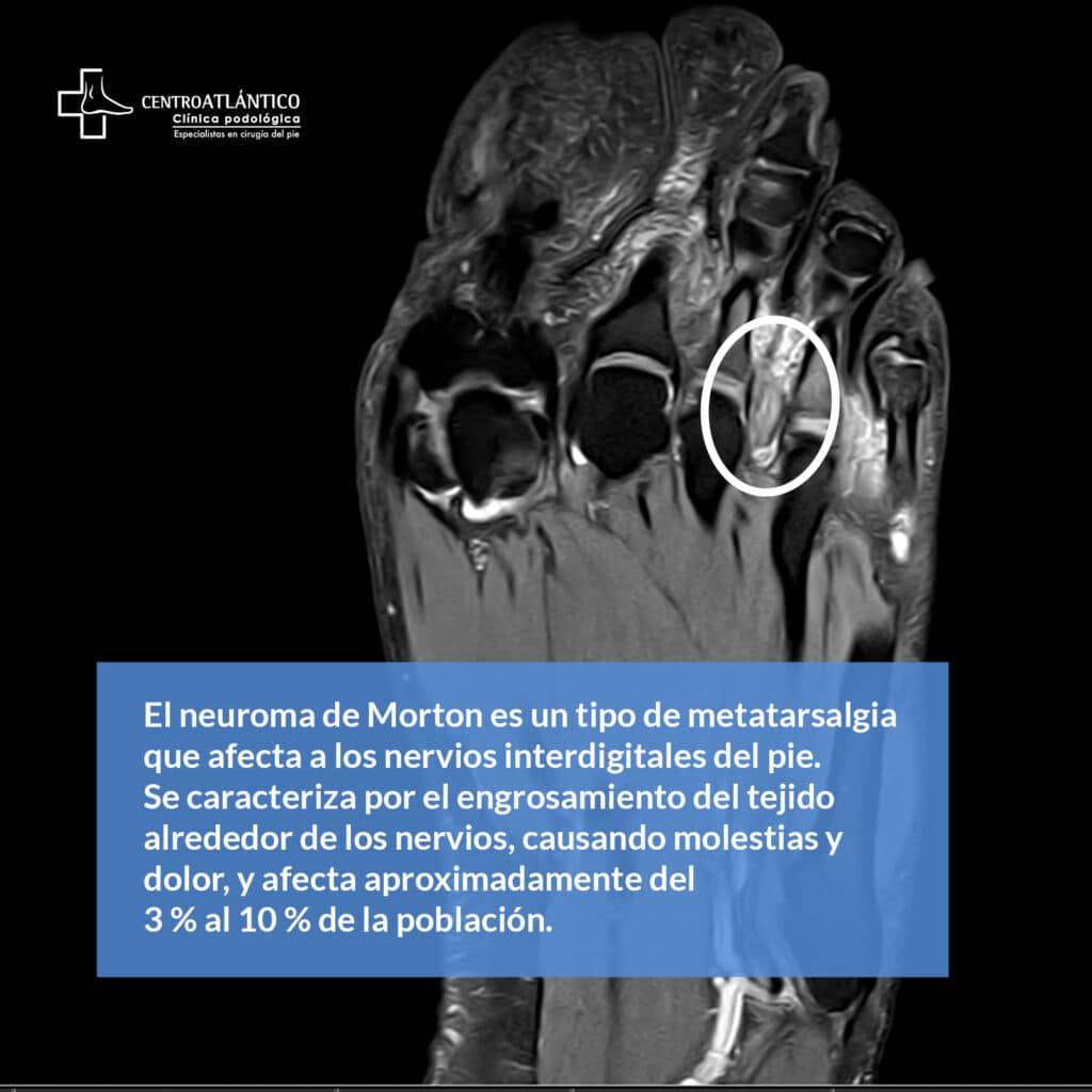 Neuroma de Morton - Causas, síntomas y tratamientos - Centro Atlántico
