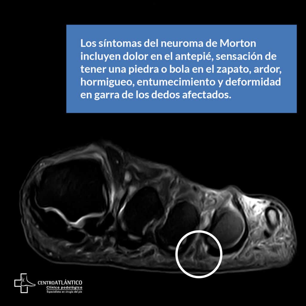 Neuroma de Morton - Causas, síntomas y tratamientos - Centro Atlántico