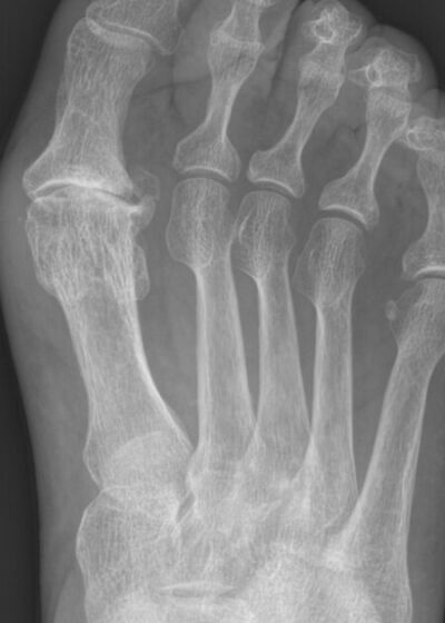 Hallux rigidus o artrósis metatarsofalángica , cómo resolverlo - Centro ...